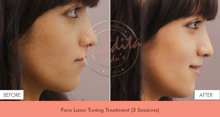 Laser Toning