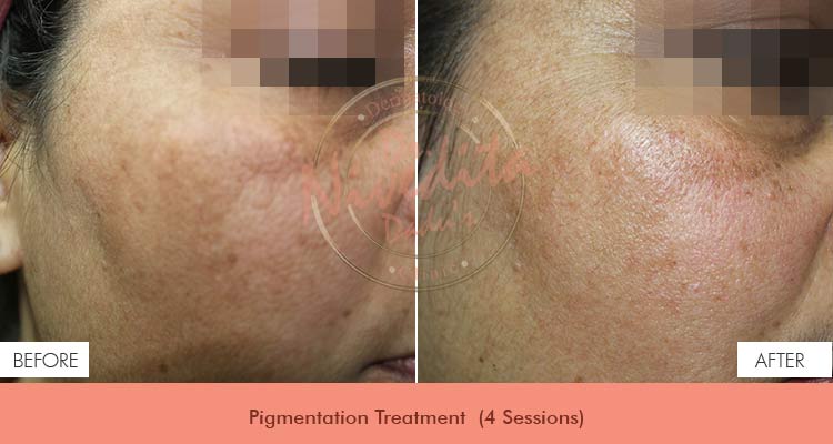 Pigmentation